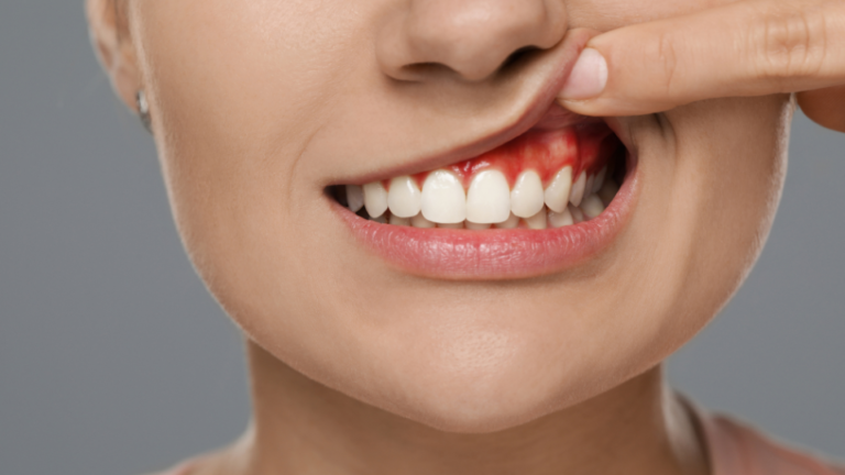 What Are the Signs of Gum Disease and How Can It Be Treated? | Gorgeous ...